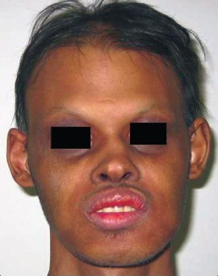 Ectodermal Dysplasia Maxillary And Mandibular Alveolar Reconstruction