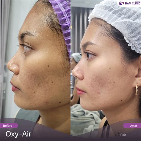 Acne Treatment Before And After Photos Siam Clinic Thailand