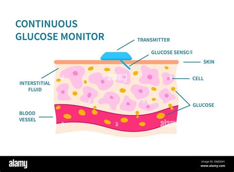 Continuous Glucose Monitor Illustration Stock Photo Alamy