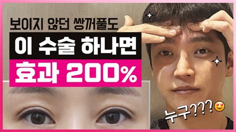 답답한 눈 탈출 아직도 이 수술방법 모른다구요 Youtube