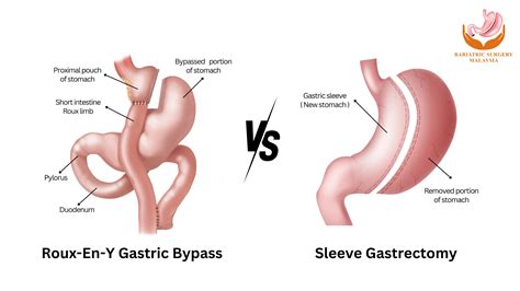 Sleeve Gastrectomy Vs Gastric Bypass