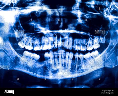Panoramic Dental Tooth X Ray Radiography For Dental Structures
