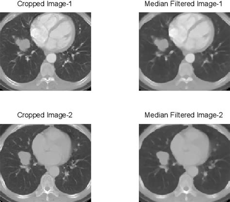 Figure 4 From Lung Cancer Detection And Classification Using Ct Scan
