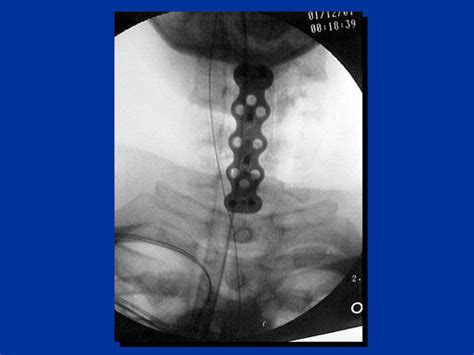 Cervical Spine Injury C Spine Clearing The Cervical Spine Ppt