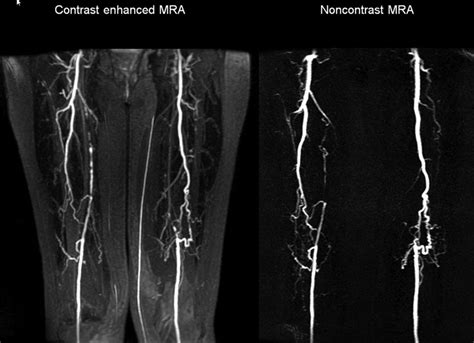 Approach To The Patient With Peripheral Arterial Disease Circulation