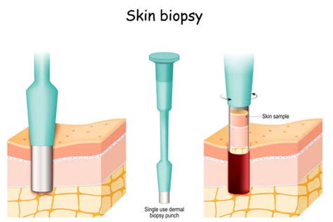Skin Biopsy Skin Biopsy Advanced Dermatology Of The Midlands Omaha