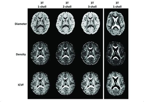 Outcome Comparison Between Single Shell And Multi Shell Acquisitions