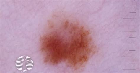 Melanoma In Situ Dermoscopy Image