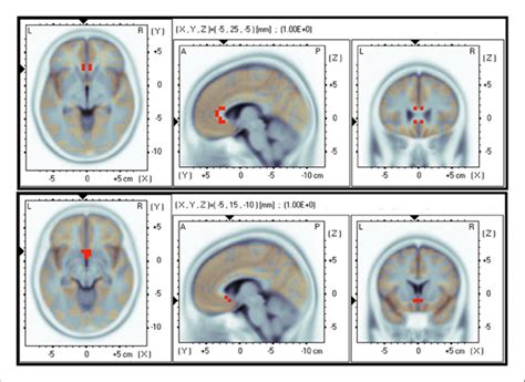 Anterior Cingulate Cortex Acc Regions Of Interest Rois Top Panel Download Scientific