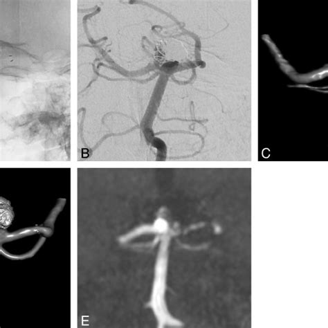 Native A And Dsa Images B After Stent Assisted Coil Download Scientific Diagram