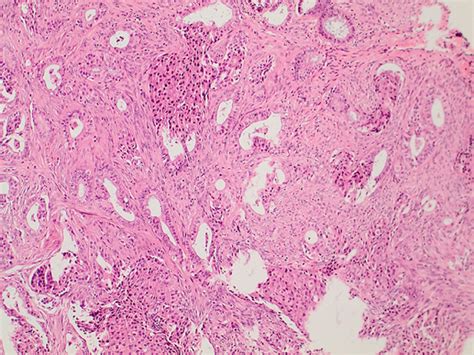 Surgical Treatment Of A Rare Case Of Atypical Polypoid Adenomyoma Of