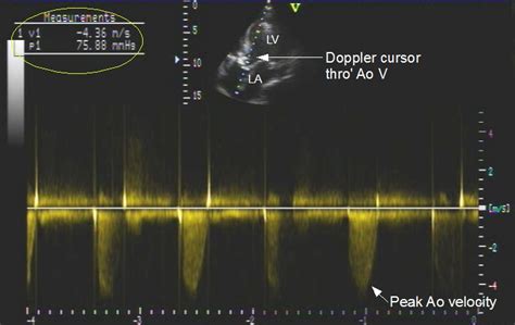 Continuous Wave Cw Doppler Imaging In Aortic Stenosis