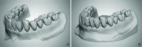 Examples Of Stl Files A Direct Digital Scan B Indirect Digital