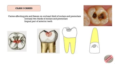Quick Revision Of G V Blacks Classification Of Dental Caries Youtube
