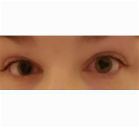 Year In Review Uveitis Edition R Uveitis