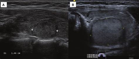 Concordant Fine Needle Aspiration Cytology Fnac Indication A Solid