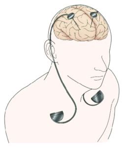 DBS For OCD Techniques Working And Benefits