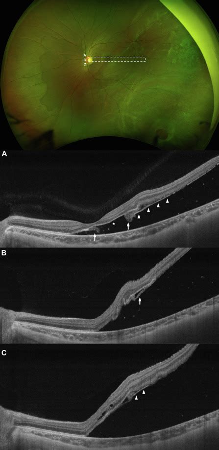 Assessment Of Proliferative Vitreoretinopathy In Rhegmatogenous Retinal