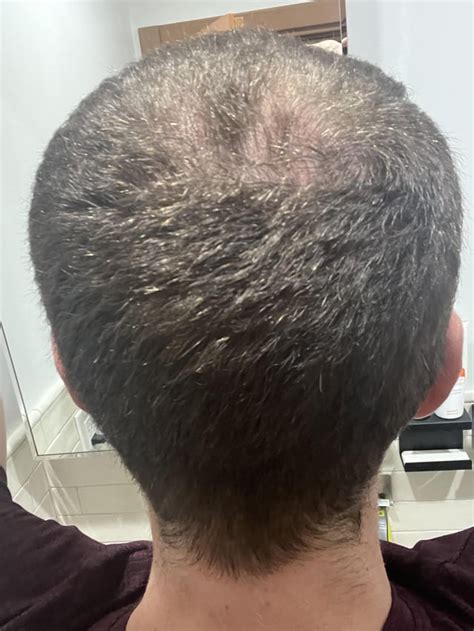 3 Month Update Dr Canberk Turan Medblu R Hairtransplants