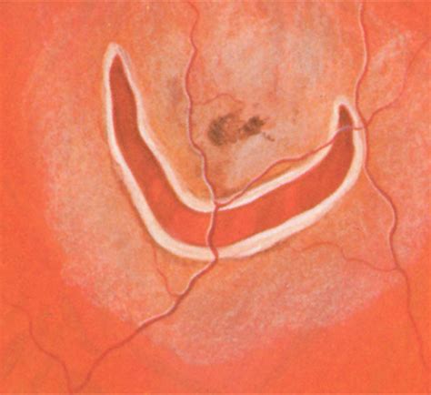 Retinal Detachment Flashcards Quizlet