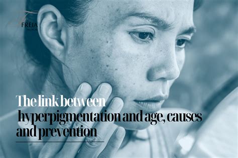 The Link Between Hyperpigmentation And Age Causes And Prevention Hair Transplant And