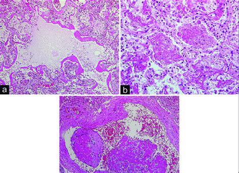 A Diffuse Alveolar Damage In A Severe Acute Respiratory Syndrome Download Scientific Diagram