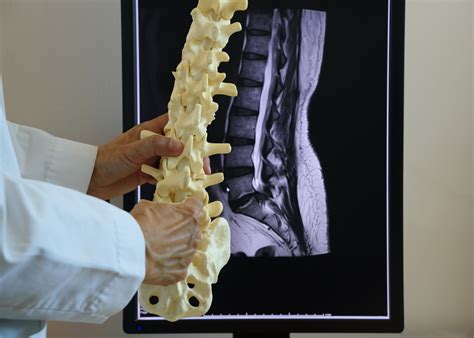 Avoiding Failed Back Surgery Syndrome Best Health System