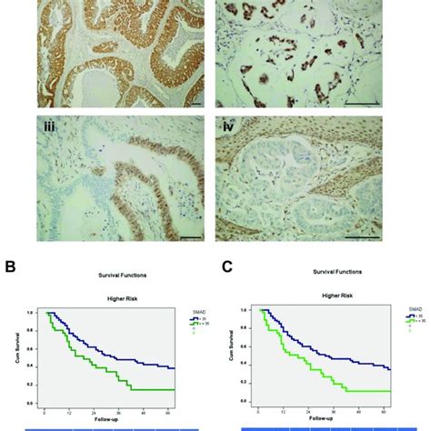 Smad4 Expression Patterns And Correlation With Survival A
