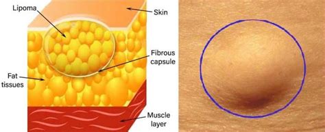 Lipoma Skin Condition Causes Symptoms Diagnosis And Treatments