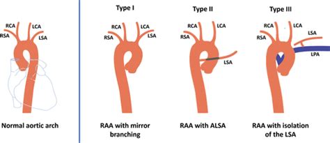 Interarm Blood Pressure Difference Revealing A Right Sided Aortic Arch