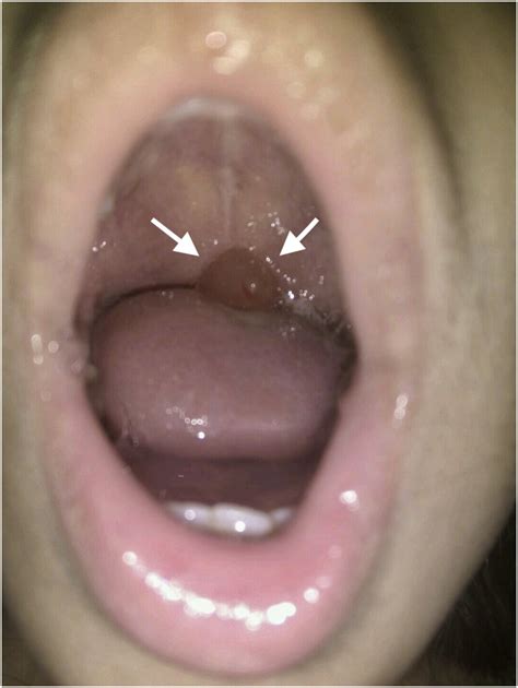 Uvula Edema And Diarrhea In An Eight Year Old Girl Journal Of