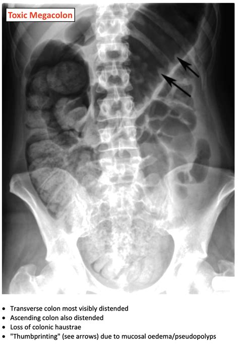 Acute Ulcerative Colitis And Toxic Megacolon On Axr Emcyclopedia