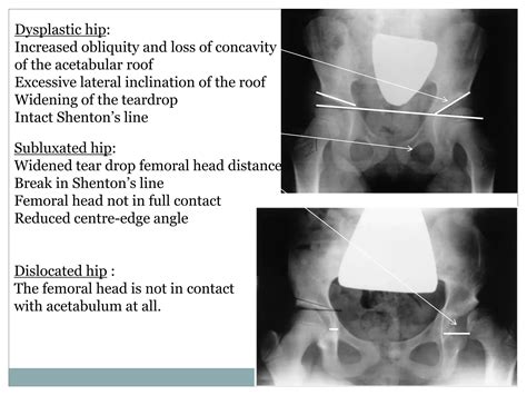 Developmental Dyspalsia Of Hip Pptx