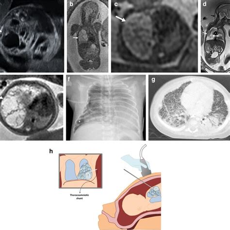 A Hybrid Lesion Intralobar Sequestration And Congenital Pulmonary Download Scientific Diagram