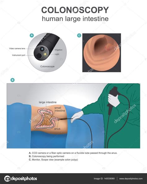 Colonoscopy Human Anatomy Illustration Vector Art — Stock Vector © Pattarawit 140538060