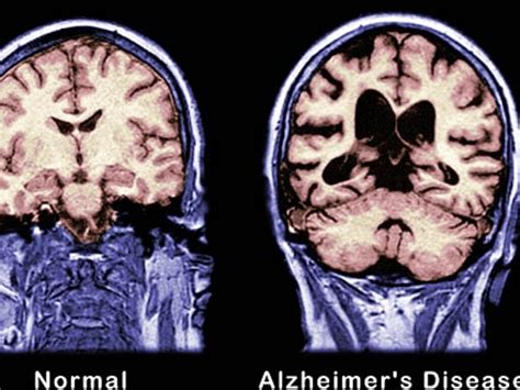 Is Too Much Of A Good Thing Behind Alzheimers Disease Scientists To Test Theory Nt News