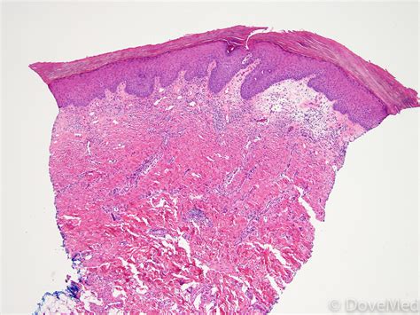Vulvar Lichen Sclerosus Lichen Sclerosus 難病 Zpfql