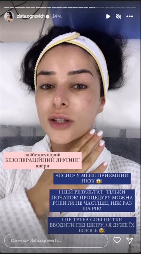 Злата Огнєвіч зняла на відео як їй роблять підтяжку обличчя Афіша