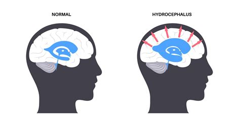 Hydrocephalus In Newborns Causes And Treatment The Clark Law Office