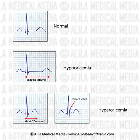 Hypocalcemia Ekg
