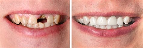 Front Tooth Root Canal