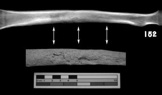 Gummatous Lesions On Left Radius Top X Ray View Showing Sclerotic