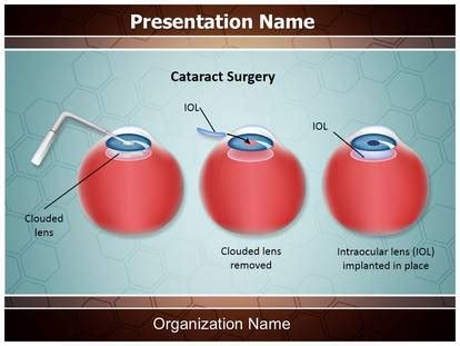 Free Ophthalmology Cataract Surgery Medical PowerPoint Template For Medical PowerPoint Presentations