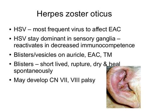 Otitis Externa