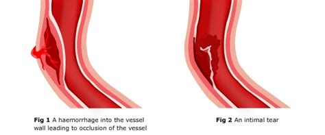 Carotid And Vertebral Artery Dissection Rcemlearning India