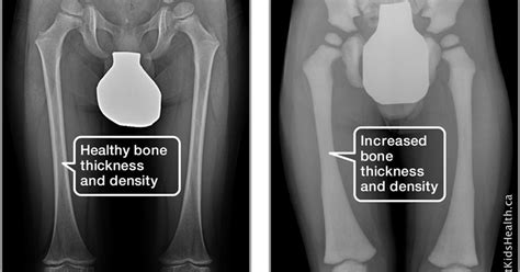 Conditions That Affect The Bones Healthcare Blog Article By Dr O