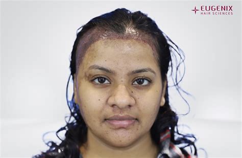 Priya Agrahari Female Hair Transplant Results And Hair Restoration