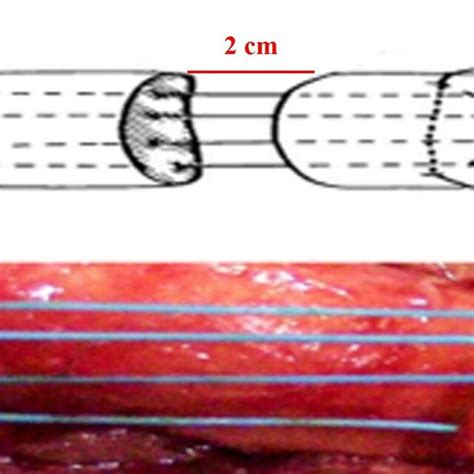Showing The Draw Of The Double Locking Loop Suture Easley Et Al 1990 Download Scientific