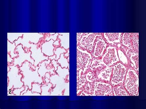 Secondary Lobule L Normal Lung Histology L Inflammatory