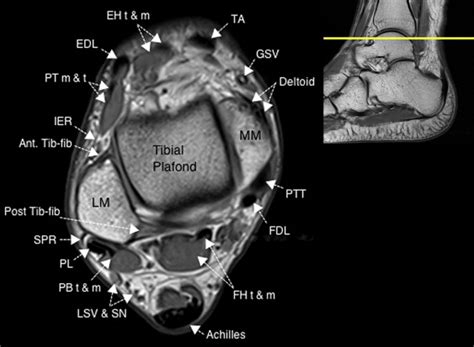 Ankle Mri Anatomy Mri Of The Ankle Detailed Anatomy Zryt